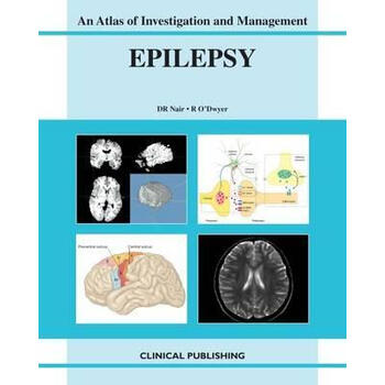 Epilepsy