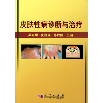 皮肤性病诊断与治疗 吴志华,史建强,陈秋霞 科学出版社